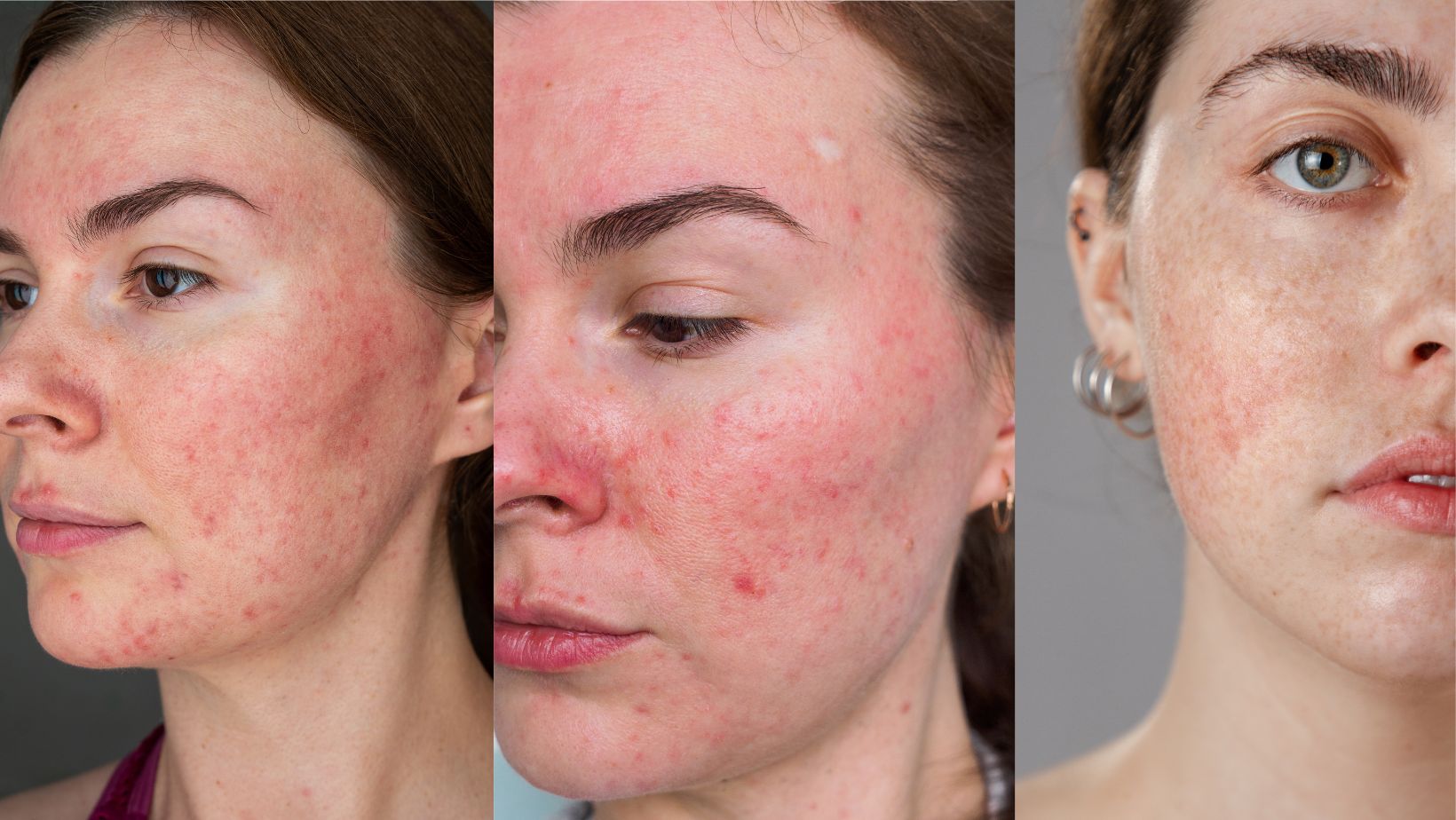 Descifrando la Rosácea: Estrategias Efectivas para un Rostro Libre de ...